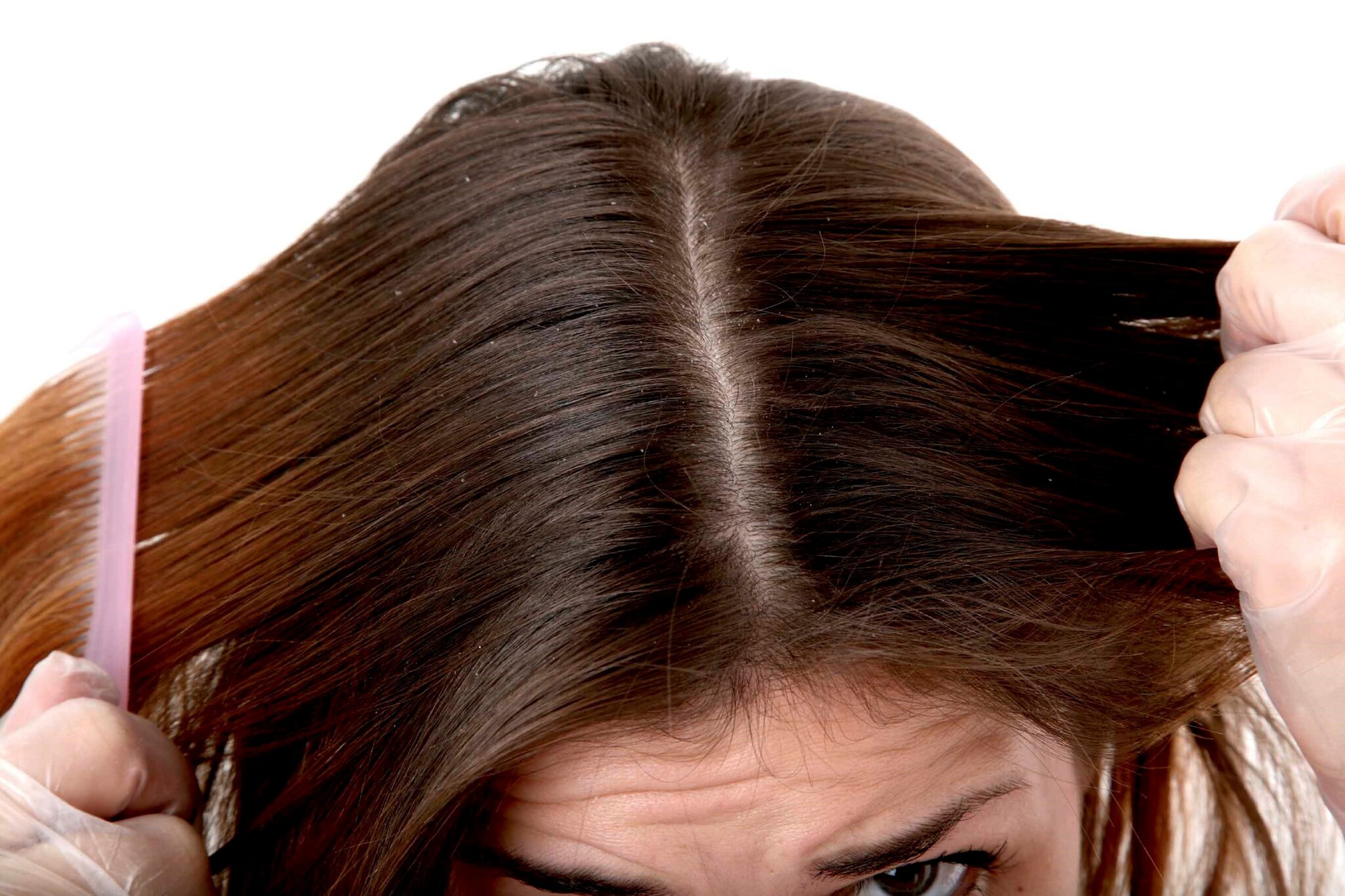 Dandruff Vs Dry Scalp Whats The Difference